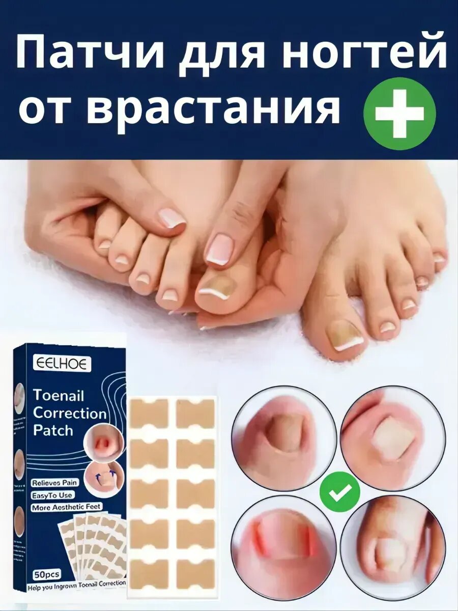 Патчи пластырь от вросших ногтей подологический скоба
