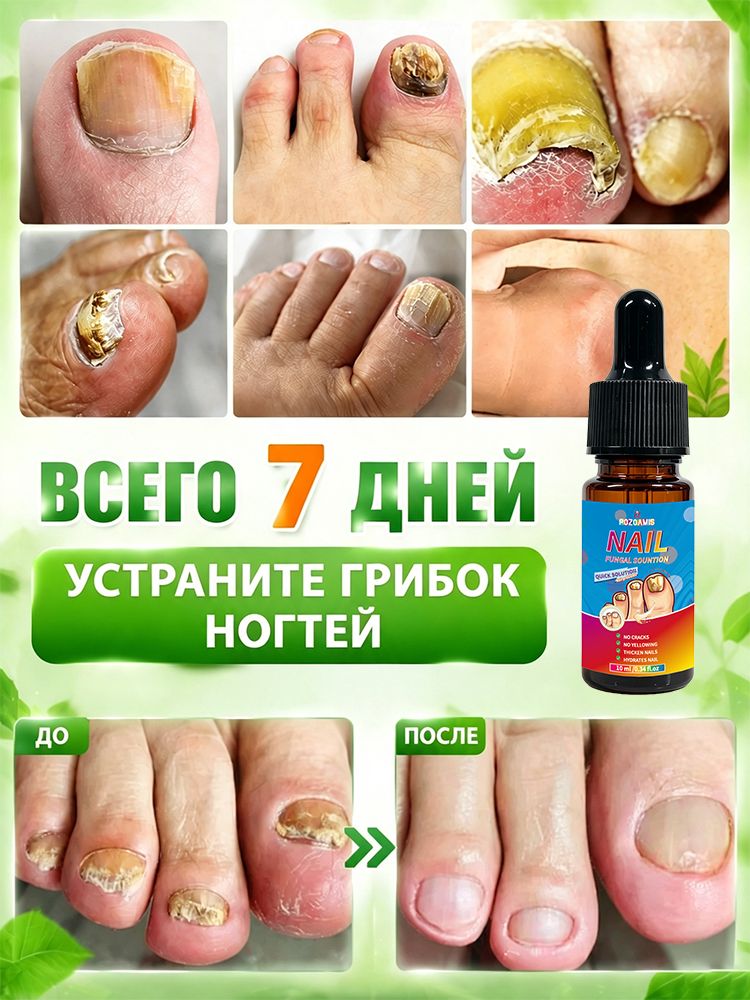 Противогрибковый лак для ногтей, устраняет инфекцию за 2 недели, восстанавливает ногти, 1 флакон