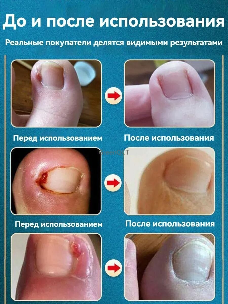 Размягчитель для вросших ногтей на ногах и руках экспресс