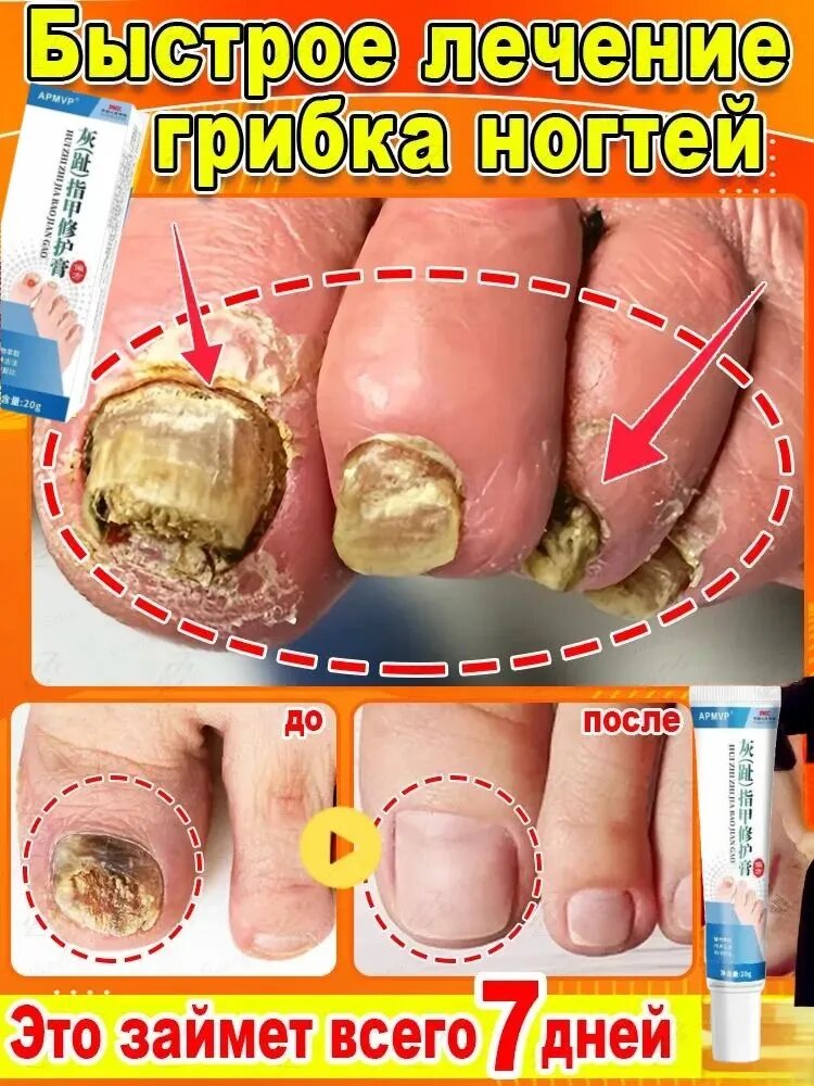 Используется для лечения грибка ногтей на ногах. Удаление грибковых инфекций, противогрибковые средства, Онихолизис , Ремонт ногтей. 90 мл