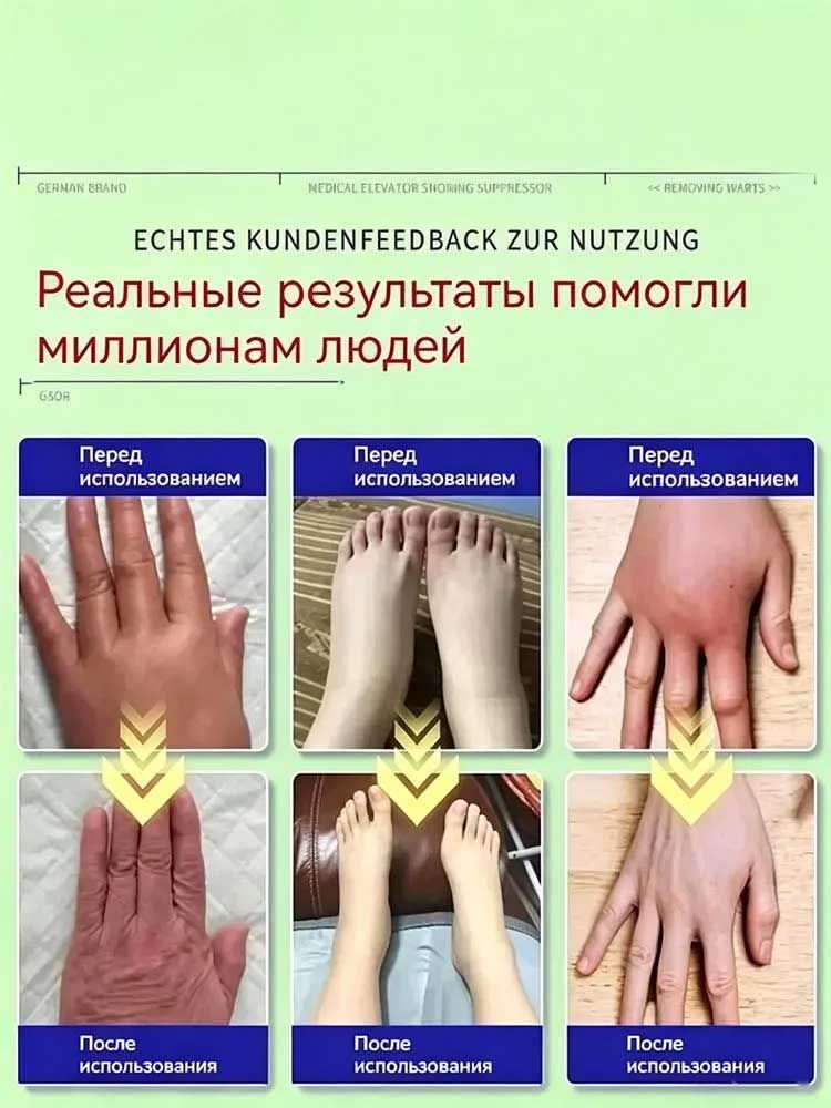 Пластырь от отеков ног, лимфодренаж от отеков, пластыри для ног,6 шт.