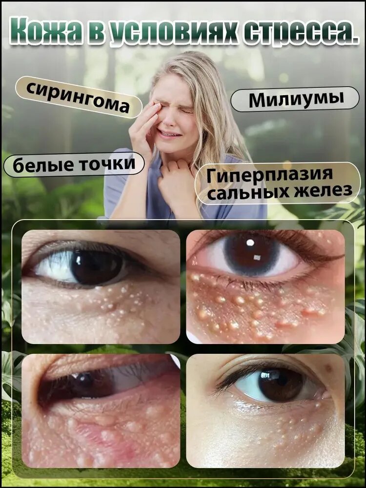 Качественный крем от просянки под глазами, 30 г