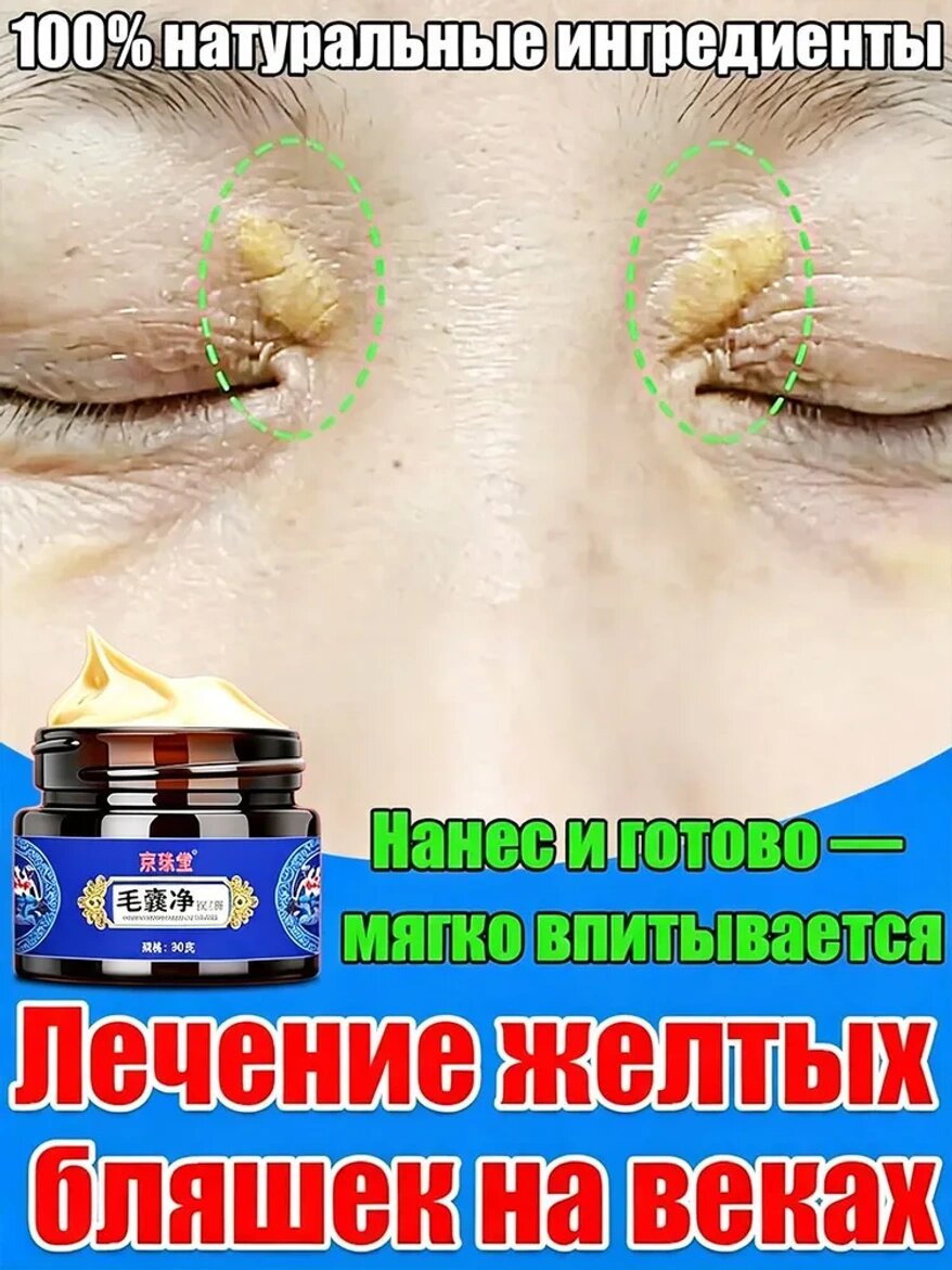 Мазь от ксантелазмы и жировиков на веках, 30 г, на растительной основе