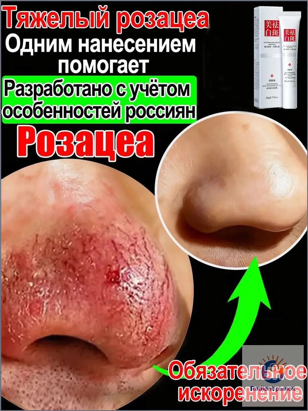 Крем от купероза для лица покраснений на лице и розацеа, Куперофаг Крем от купероза на лице, антикупероз, средство от сосудистых звездочек, от покраснений, розацеа, Китайская чудо-мазь.20 г