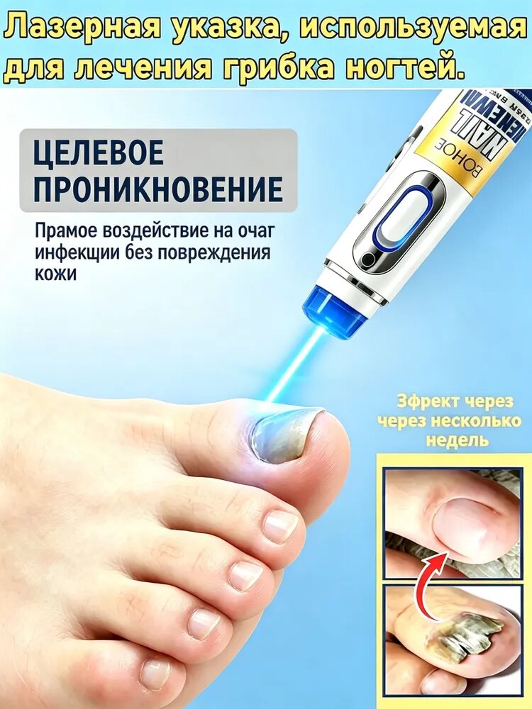 Лазерная ручка для лечения грибка ногтей, грибок ногтей на ногах лечение
