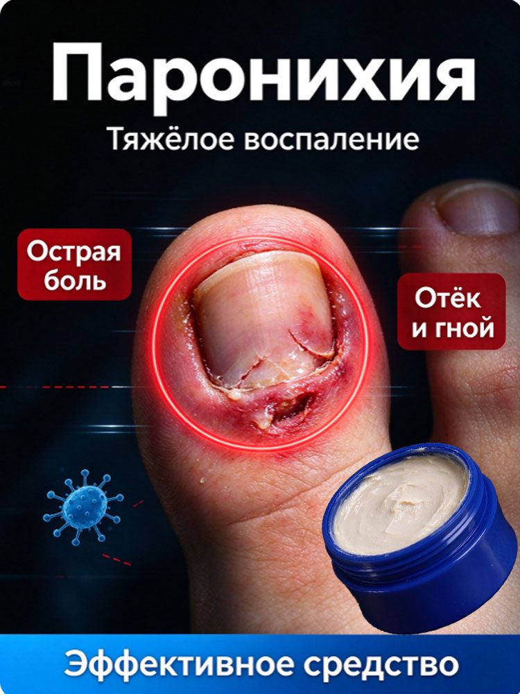 Размягчающий крем для ногтей, облегчает состояние при паронихии и отёке