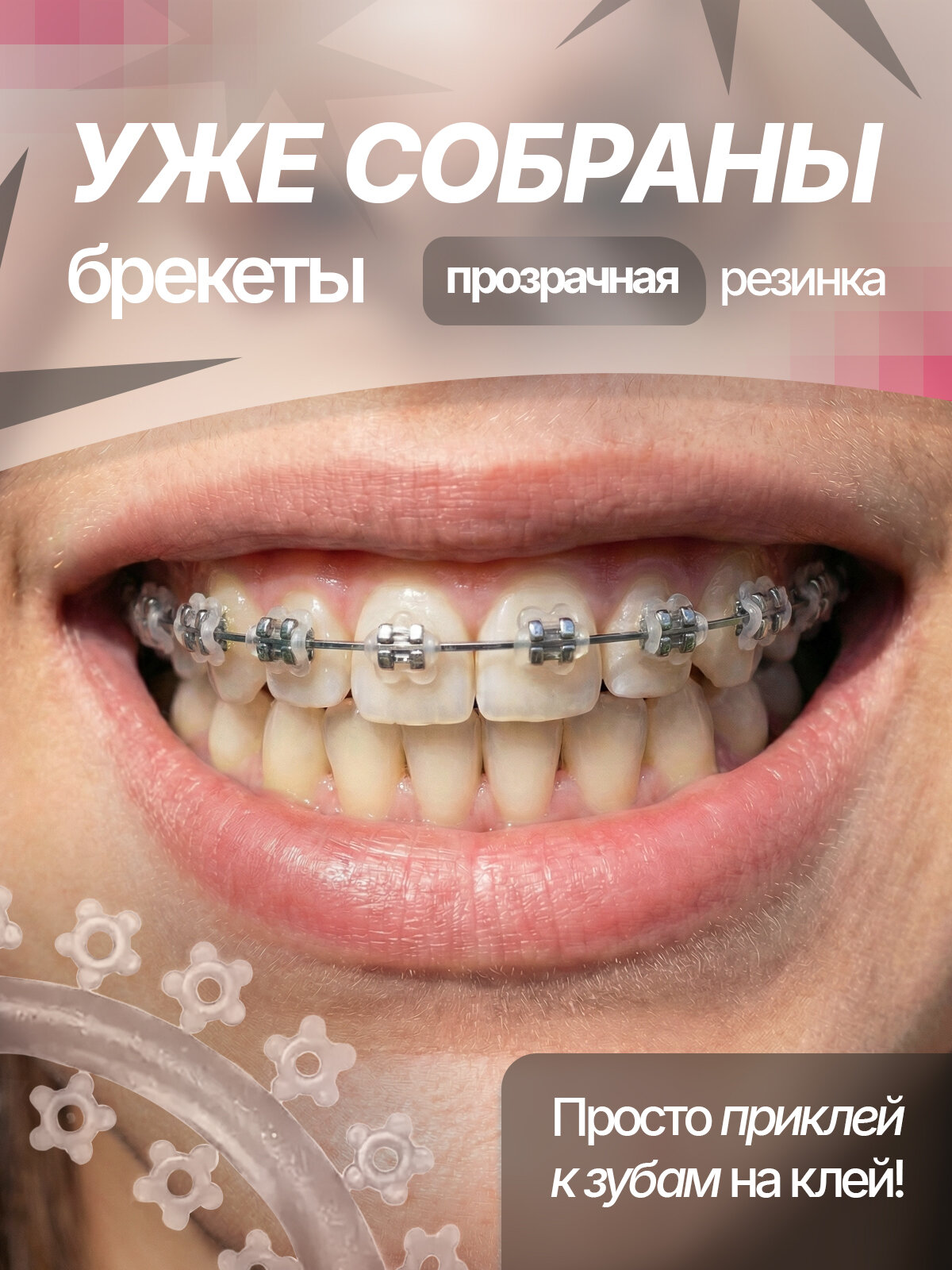 Брекеты накладные металлические для зубов