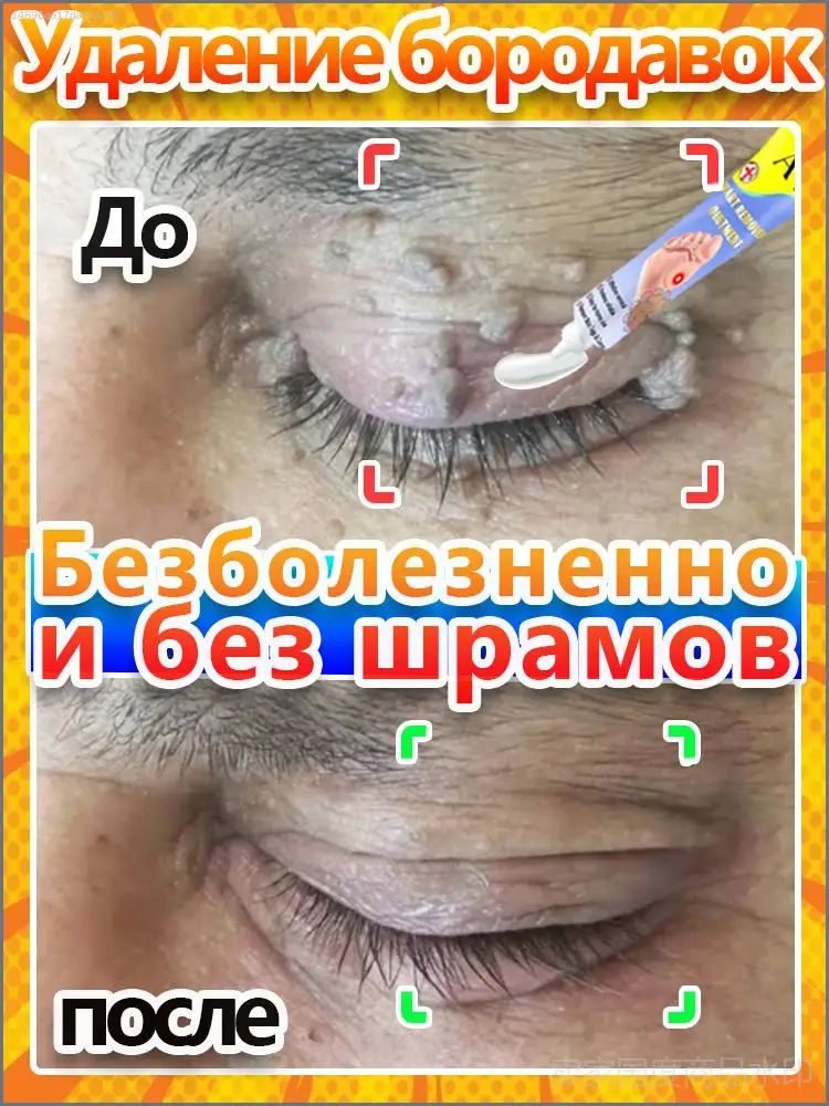 Этот крем улучшает состояние папиллом и эффективно удаляет бородавки, папилломы и родинки на лице и теле. Он безболезненный, не оставляет шрамов и не имеет побочных эффектов. 60 грамм