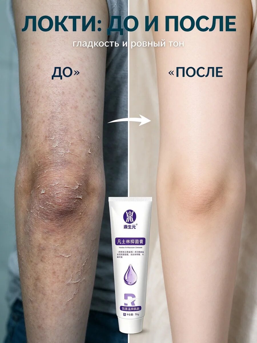 Крем пилинг мочевина 30%
