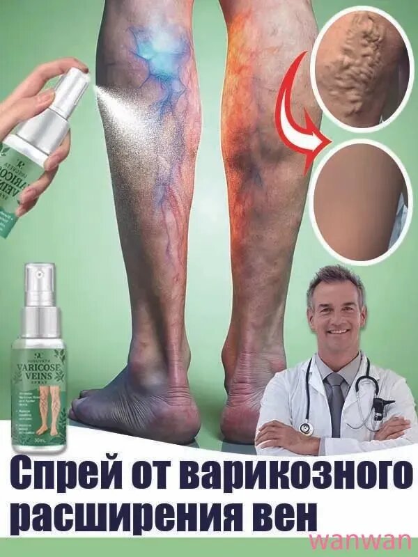 Спрей от варикоза, подходит для лечения отеков и тяжести в ногах, сосудистой сеточки, тромбов, 30 мл.