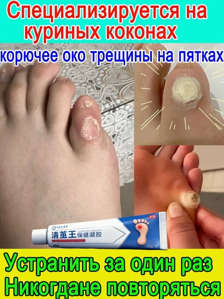 Крем для при сухой, огрубевшей коже стоп, сухих мозолях, натоптышах, нарушении кожного покрова стоп, трещинах, зуде и шелушении кожи,