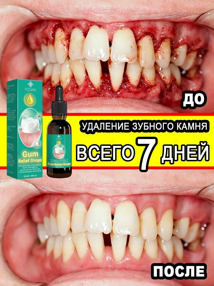 Успокаивающие капли для десен облегчают дискомфорт, такой как покраснение, отечность, кровотечение, повышенная чувствительность, рецессия и боль в деснах, одновременно увлажняя и восстанавливая их.