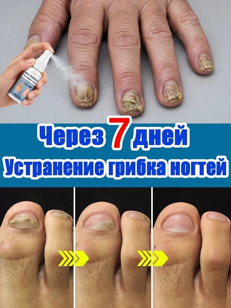 Эффективное средство от грибка ногтей на ногах, противогрибковый спрей для ног, уход за ногтями и кутикулой, 30 г