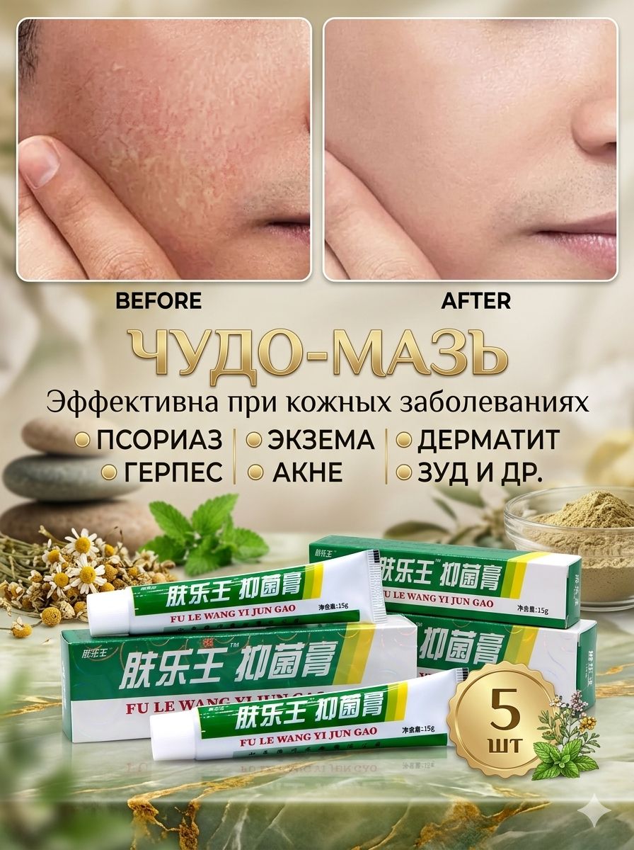 Китайская чудо мазь Ван Юэ от псориаза, экземы, дерматита, герпеса, акне, прыщей 5 шт