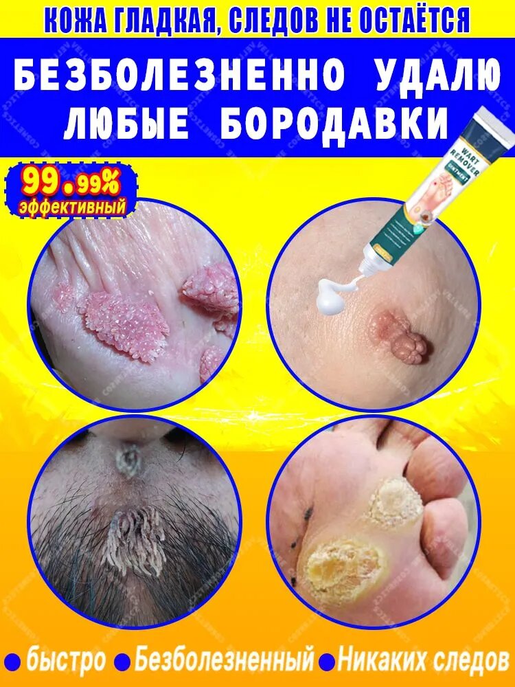 99% результат без рубцов и боли! Удаляем любые виды бородавок: подошвенные, остроконечные кондиломы, плоские, нитевидные папилломы, невусы. Безопасно и эффективно. 20 г
