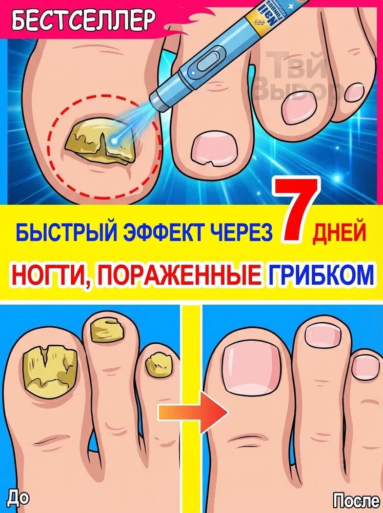 Лазерная ручка от грибка ногтей на ногах, прибор для лечения и восстановления ногтей, средство от онихомикоза