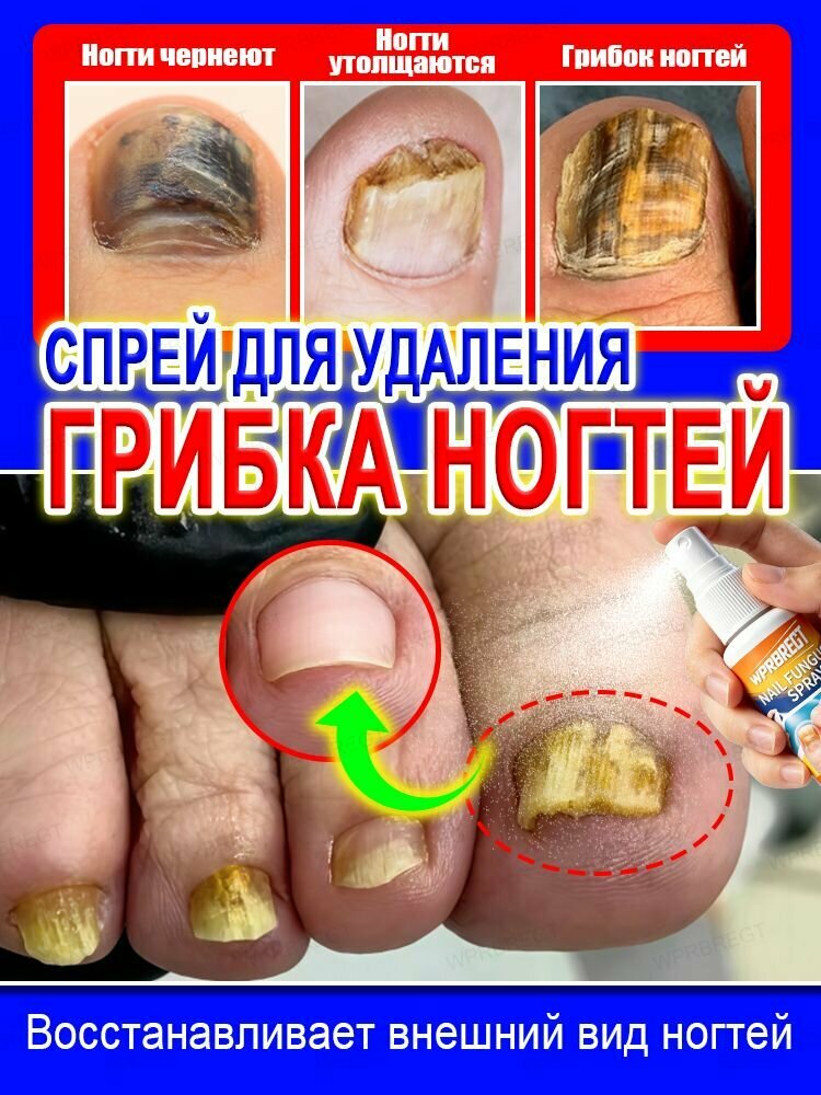 Спрей от грибка ногтей мощное антибактериальное и противогрибковое действие, быстрое размягчение и глубокое восстановление. Эффективно и безопасно. 90 мл