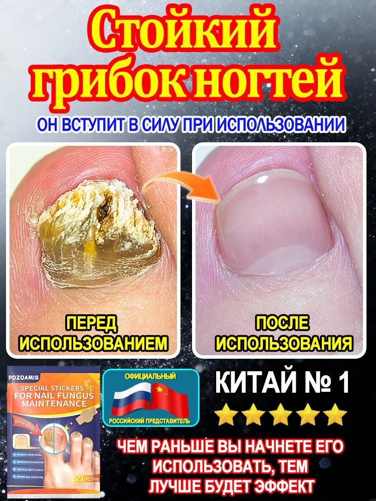 Пластырь от грибка ногтей, восстановление повреждённого ногтя, глубокое уничтожение грибка, размягчение утолщённых ногтей, рост здорового ногтя, 21шт