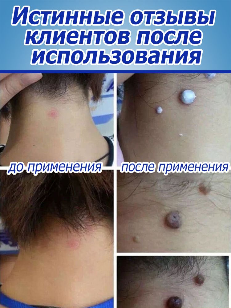 SUSUVETA Mазь от папиллом с чистотел средство от папиллом, средство от бородавок и родинок, удаление за 3 дня без боли и следов, 20 г