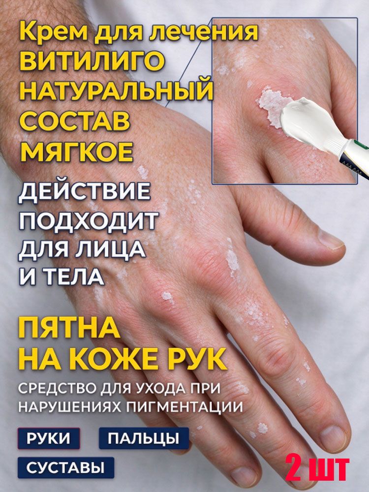 Крем для лечения витилиго, натуральный состав, для лица, тела и рук, от пятен на коже