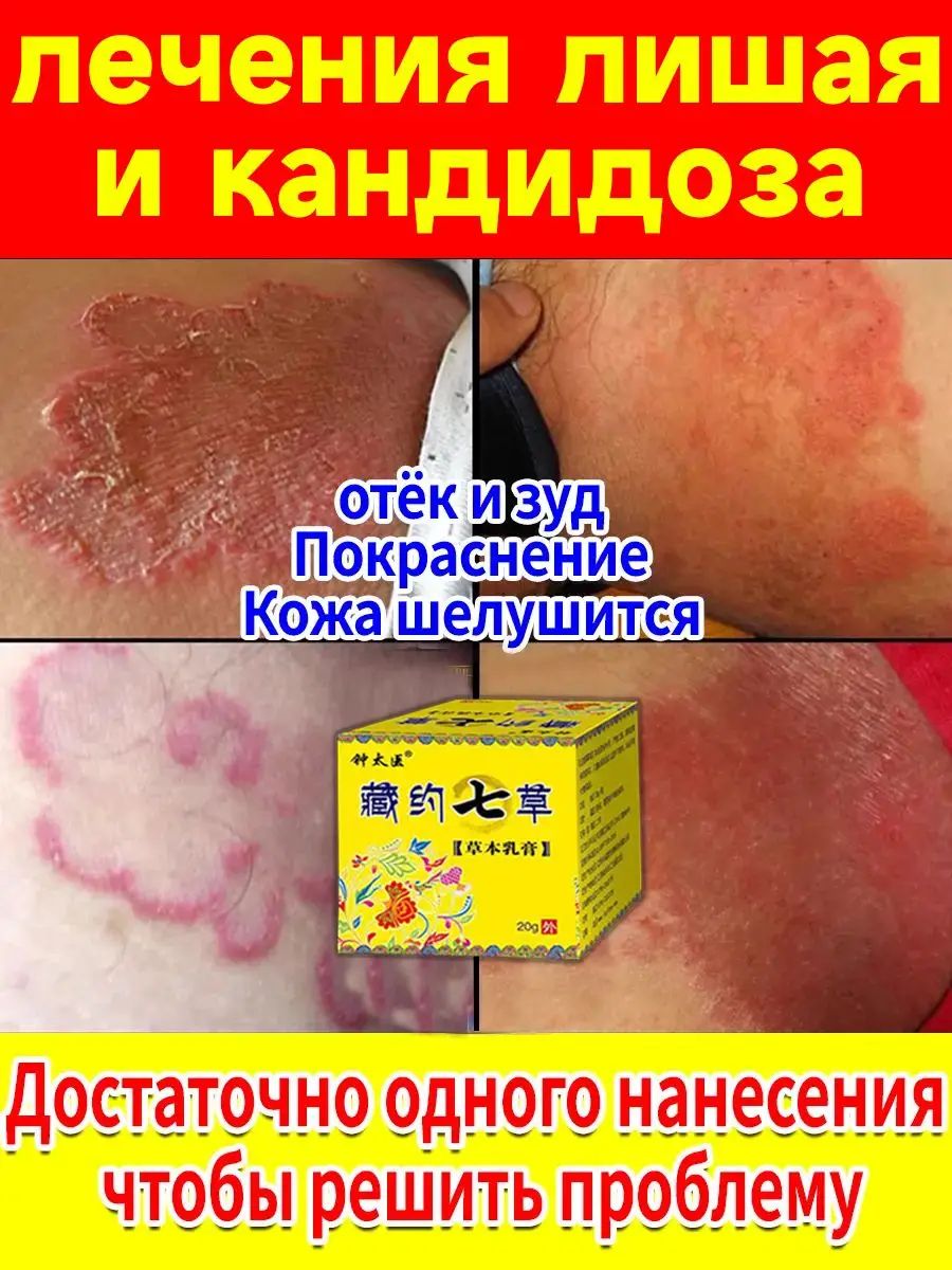 Паховый грибок противогрибковая мазь для кожи
