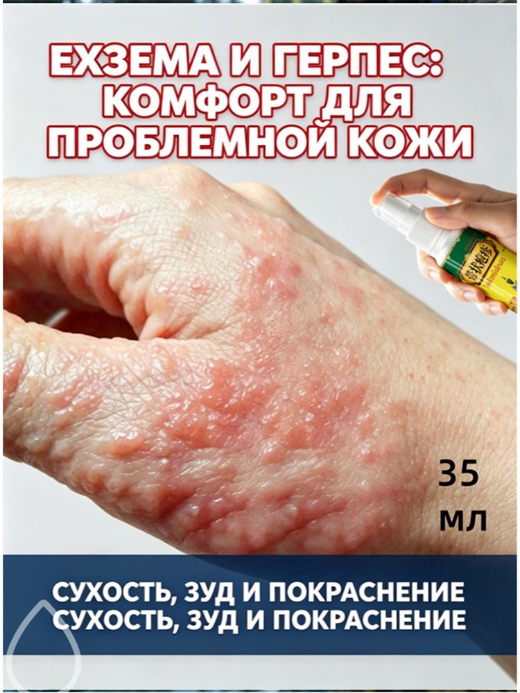 Натуральный спрей от опоясывающего лишая для головы и области за ухом, эффективно снимает боль и зуд, быстрый результат, без гормонов, удобн