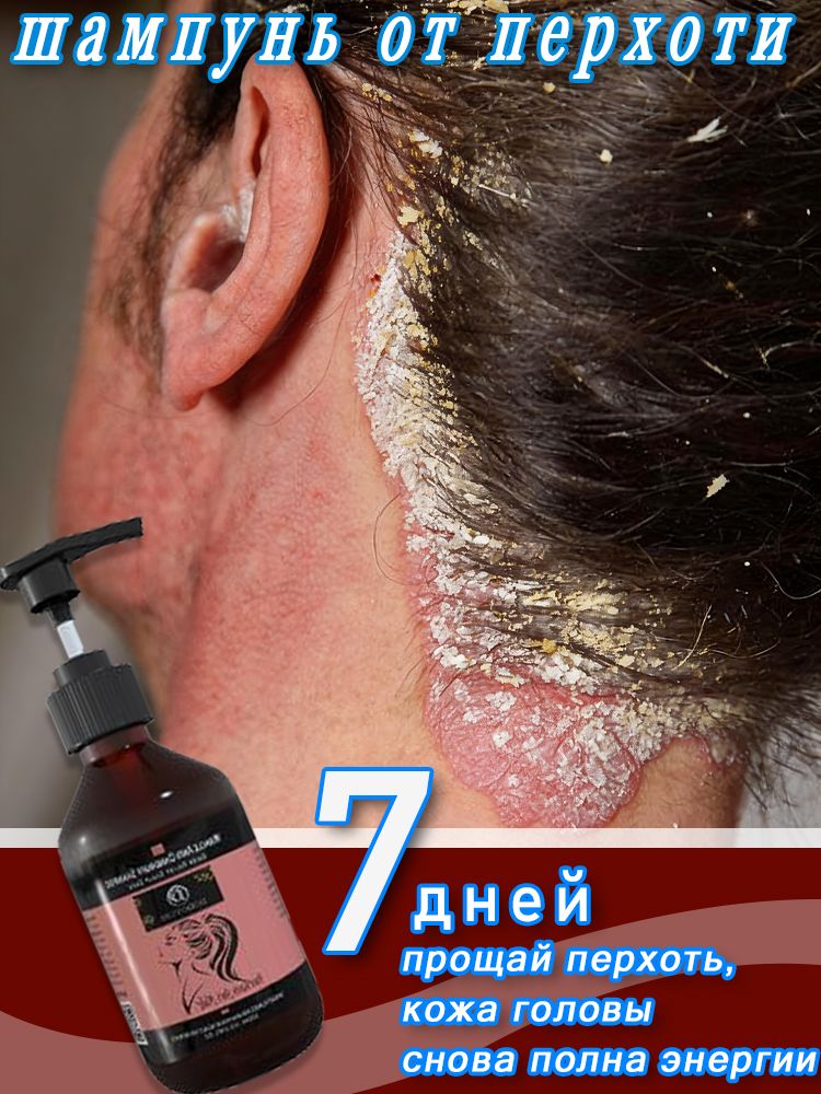 Шампунь от перхоти эффективно устраняет перхоть, уменьшает зуд при себорейном дерматите, регулирует жирность, освежает, подходит для мужчин и женщин, 300 мл