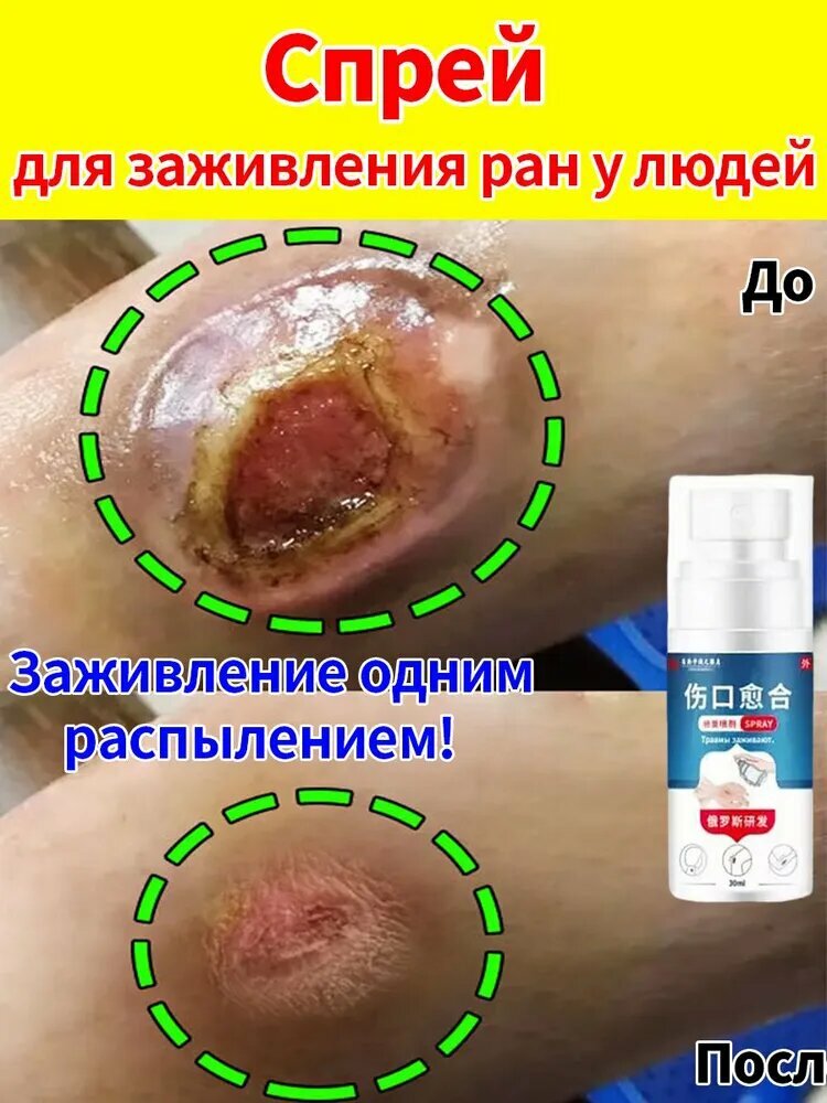 Спрей для лечения диабетической стопы и пролежней: заживление ран и регенерация кожи при сахарном диабете