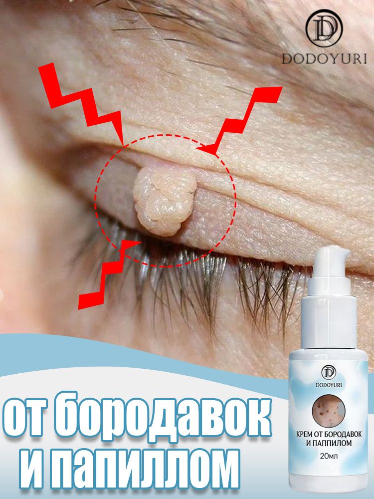DODOYURI Крем от бородавок и папиллом, быстрое удаление без ожога кожи, 20 г