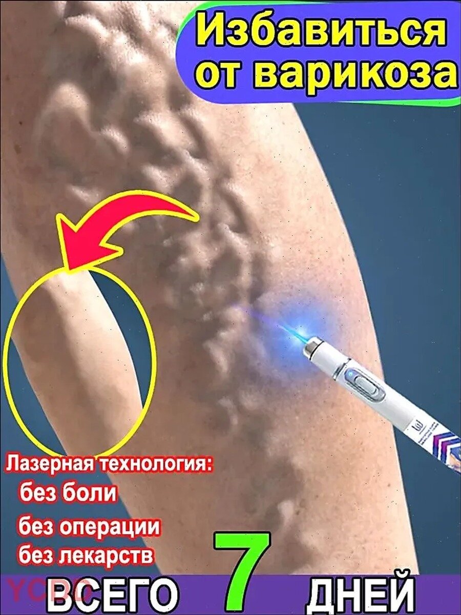 Варикозные вены. Устраняет тромбы, классическое исполнение модели, модель серии