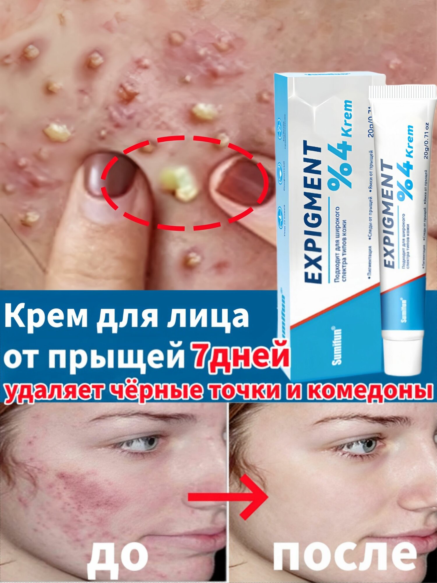 Крем для лица от прыщей, удаляет чёрные точки и комедоны, для лечения акне на спине и теле, увлажняет и сужает поры, 20 г