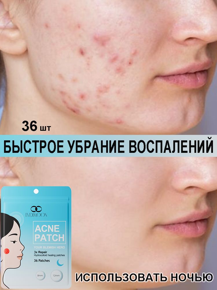 Патчи от прыщей, для лечения акне на лице, снимает воспаления, 36 шт.