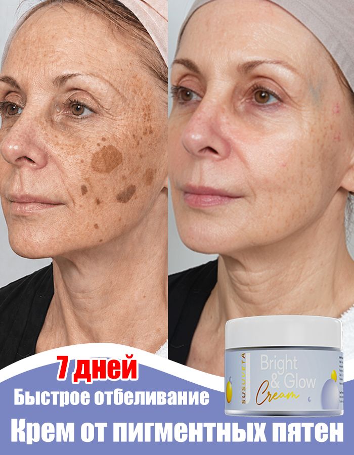 Отбеливающий крем от пигментных пятен и веснушек, против пигментации, Удаление мелазмы и пигментных пятен, Коррекция тона кожи 30г