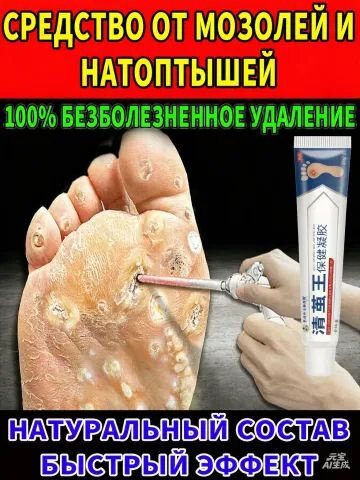 Средство от шипиц, натоптышей и сухих стержневых мозолей на ногах мазь и гель Корнекс, эффективное китайское средство