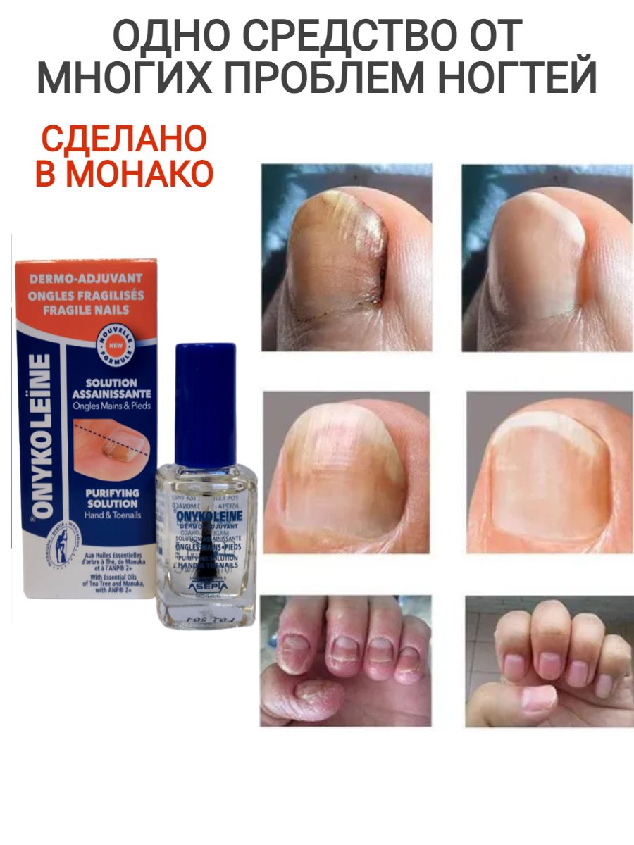 Концентрат для чувствительных ногтей Akileine Onykoleine, средство от грибка, онихолизиса, для роста и укрепления