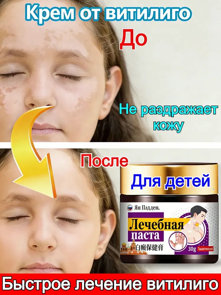 Крем от витилиго, белых пятен 30 г, для усиления пигментации при витилиго лейкодерма, лишай, бурые пятна
