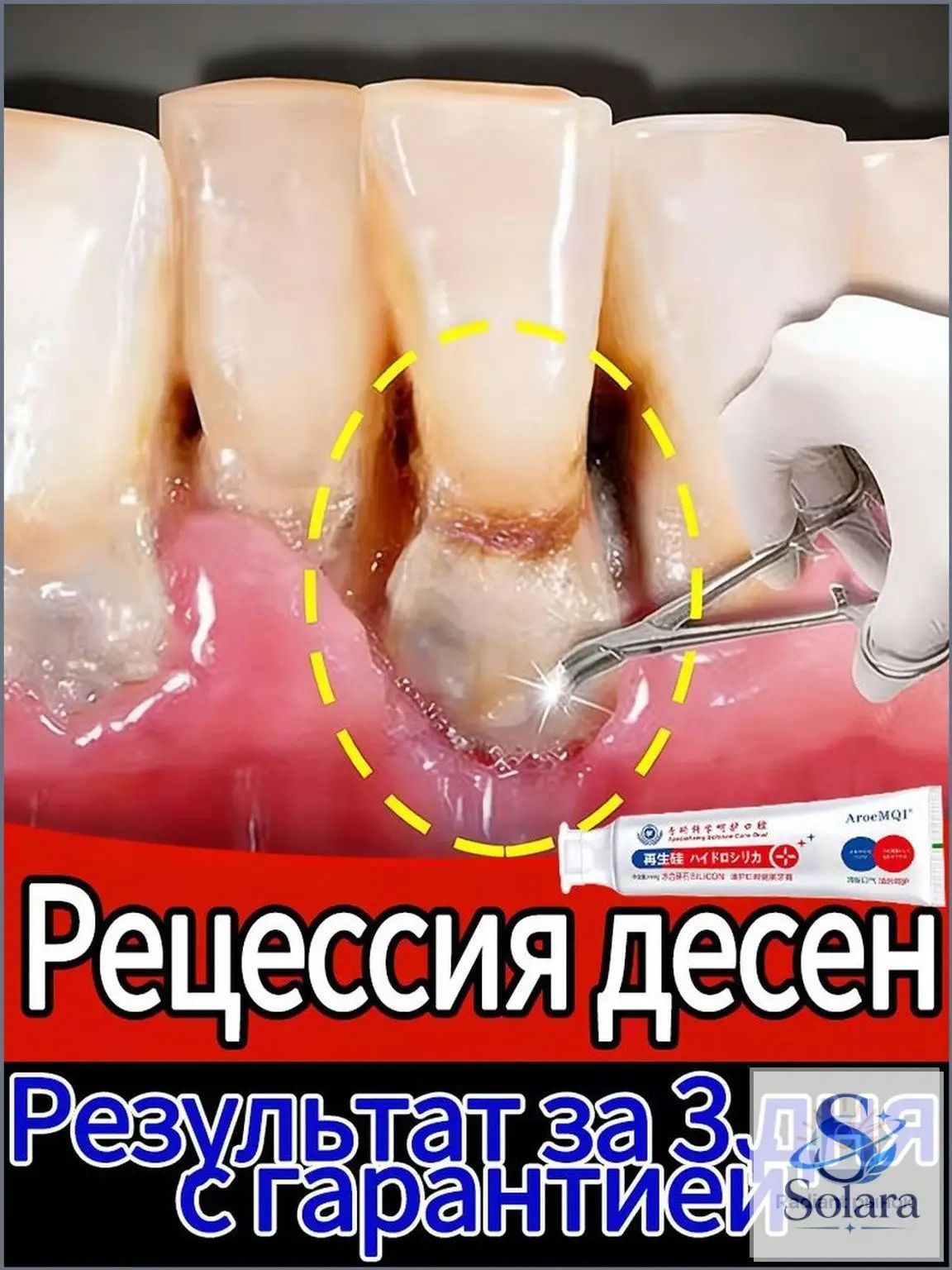 Восстановление десен и укрепление зубов при рецессии - гель с регенерирующим кремнием