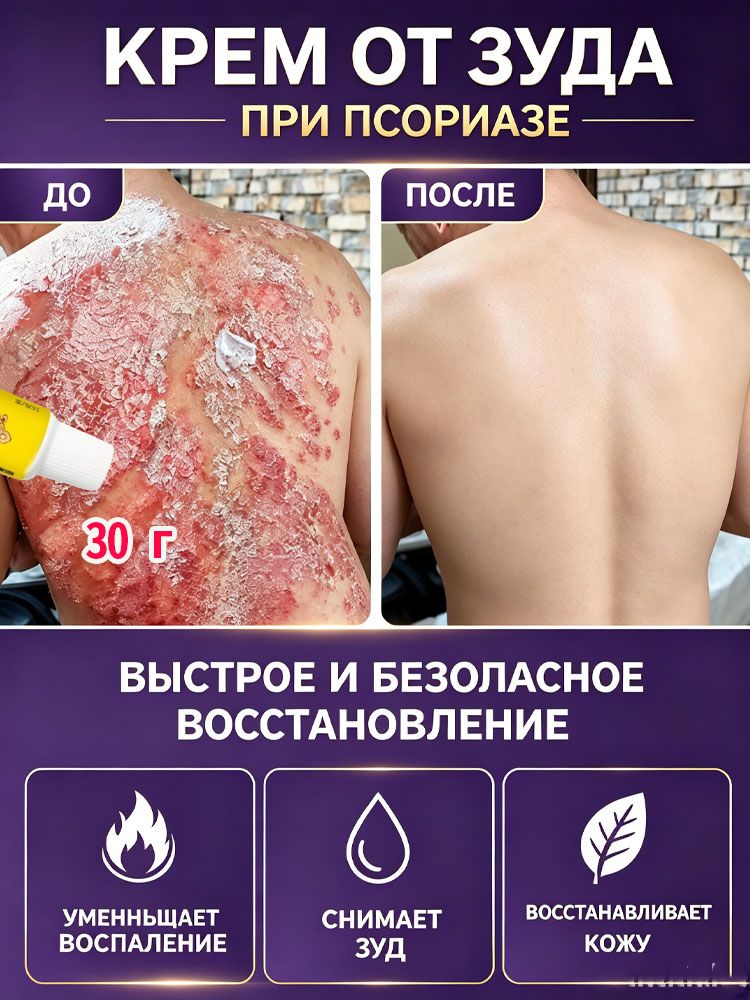 Мазь от псориаза, предназначенная для лечения псориаза, экземы, нейродермита, грибковых заболеваний, дерматита, себорейного дерматита, быстро восстанавливает здоровье кожи