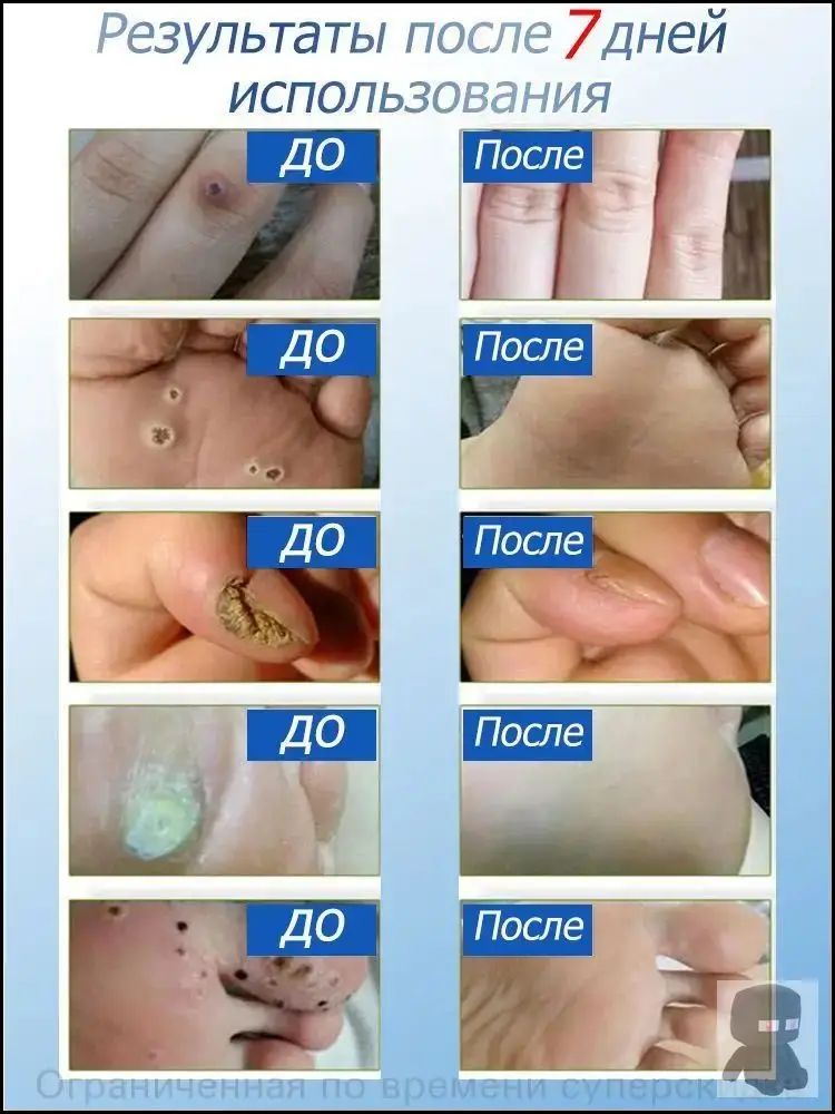 Качественное средство от папиллом и невусов, изготовленное на основе растительных экстрактов, весом 20 г