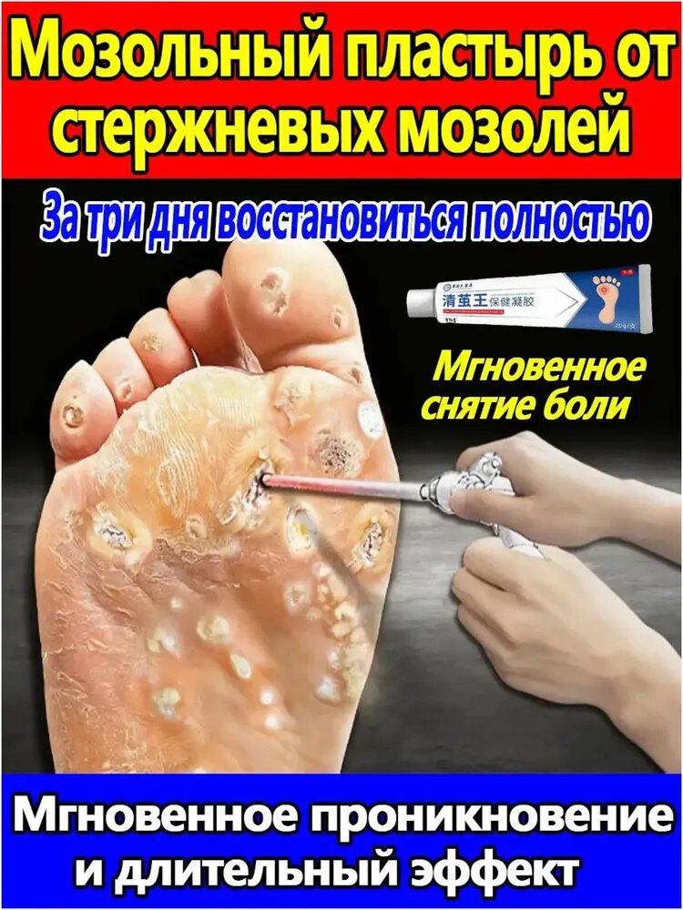Средство от шипиц, натоптышей и сухих стержневых мозолей на ногах мазь и гель Корнекс, китайская чудо-мазь,20 г