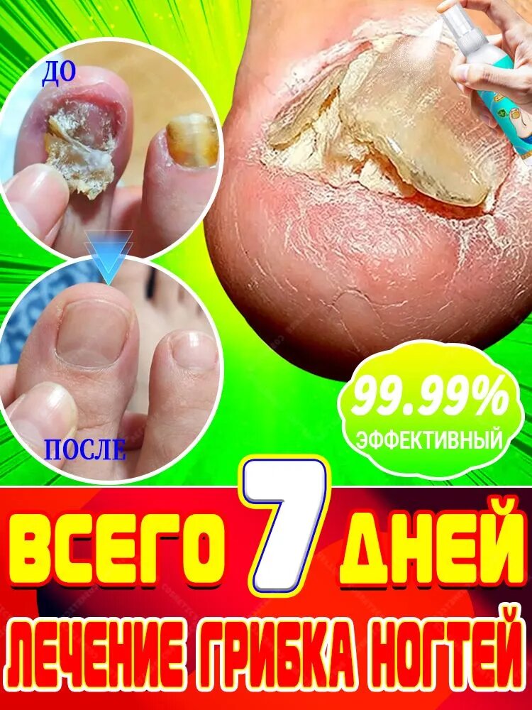 Лечит грибок ногтей на руках и ногах. Противогрибковый спрей для стоп: от трещин и зуда, укрепление ногтей при онихолизисе, устранение запаха и ороговевшей кожи. 150 мл