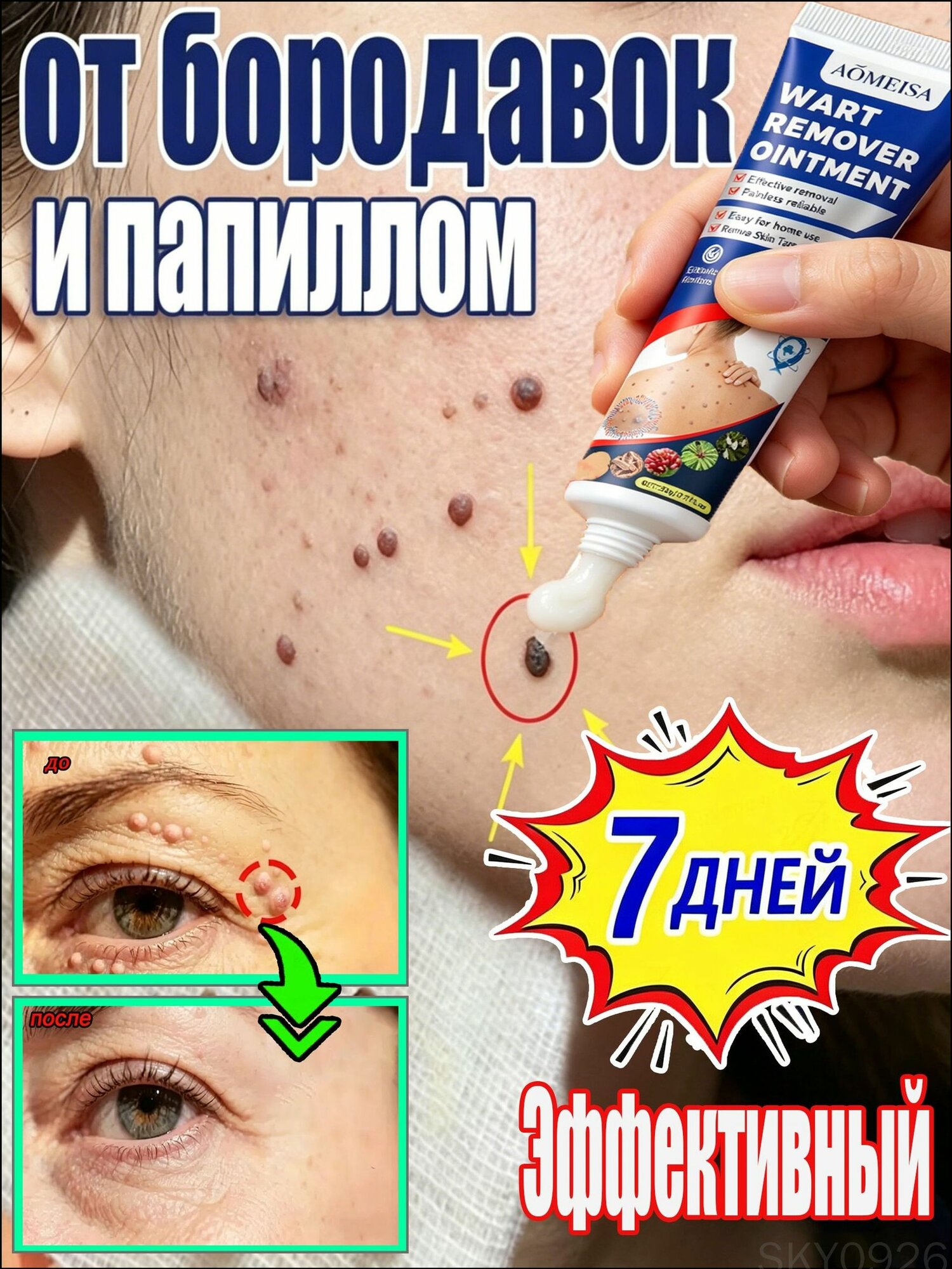 Крем для удаления бородавок. Его можно использовать для удаления натоптышей, бородавок, кожных высыпаний, папиллом и сухих мозолей. Безболезненно, без рубцов и побочных эффектов.