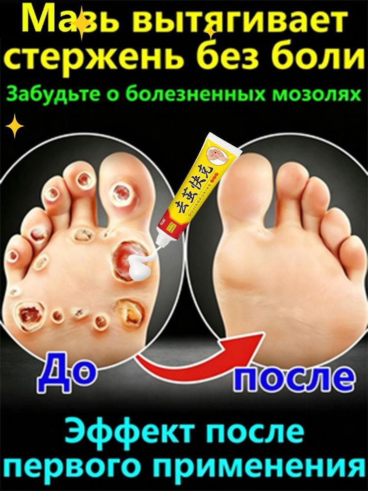 Мягкая мазь для удаления стержневых мозолей и бородавок на ступнях, безболезненное размягчение ороговевшей кожи, видимый эффект после первого нанесения, туба 20 г