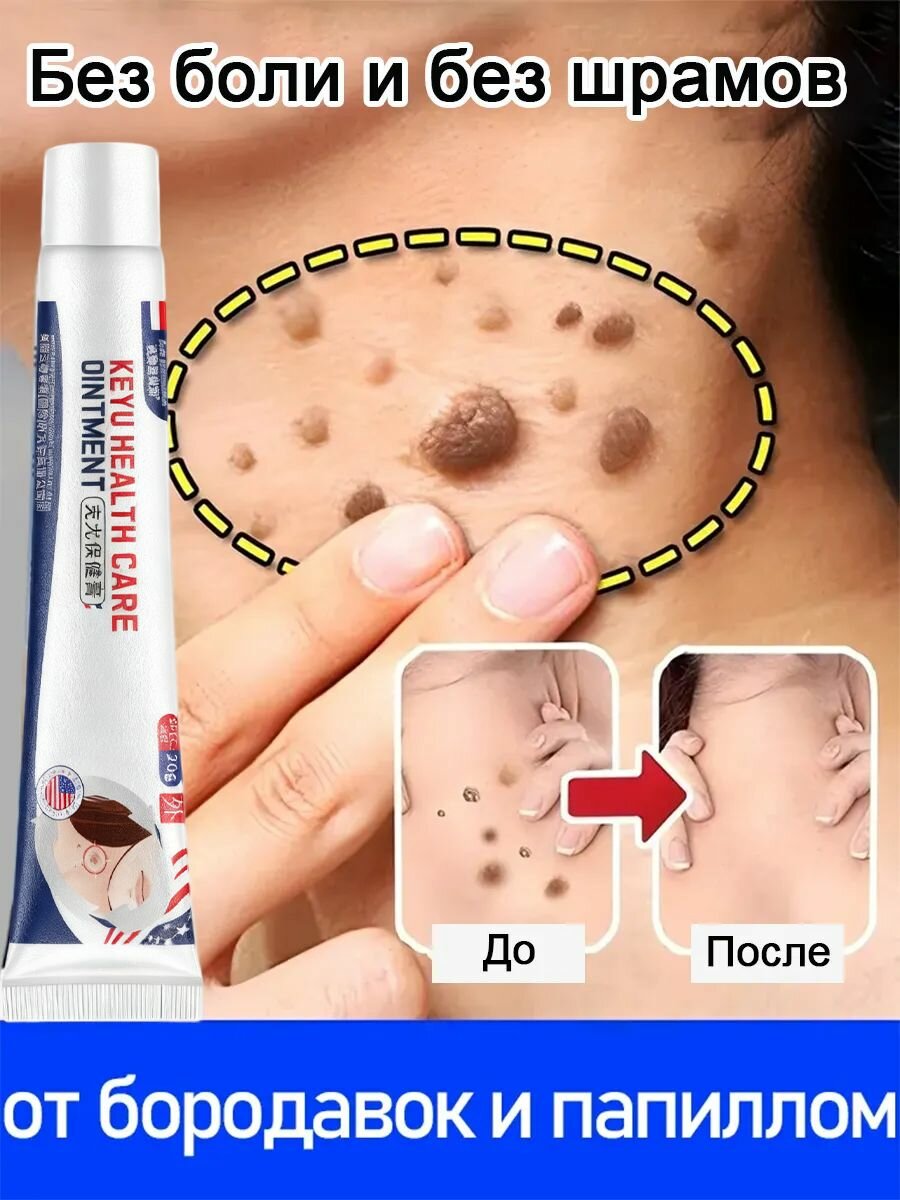 Легкое сглаживание! Упрямые подошвенные бородавки, плоские бородавки на лице. Точный эффект, без раздражения, упаковка 20 грамм.