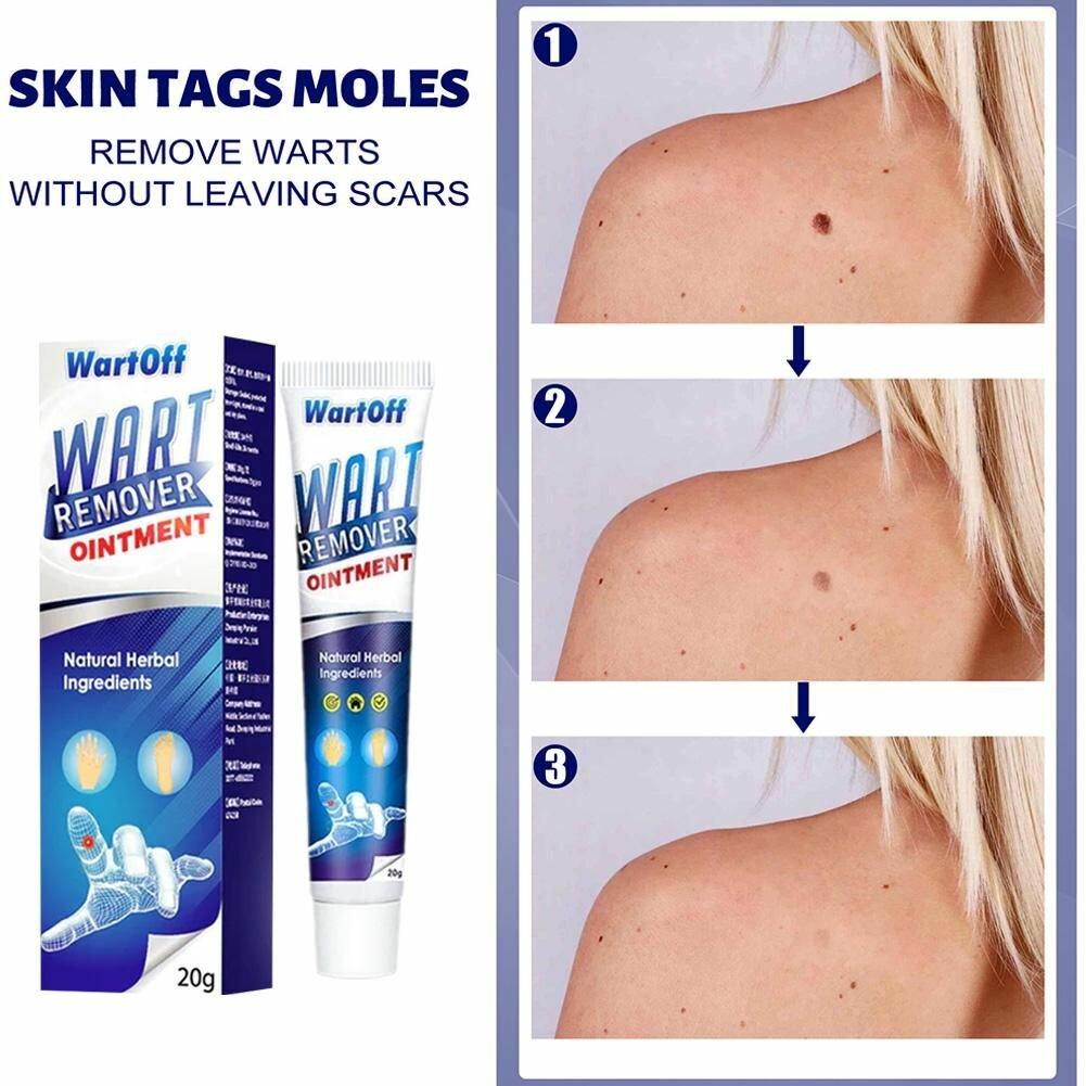 Мазь для ухода за кожей, средство для удаления бородавок, родинок и папиллом
