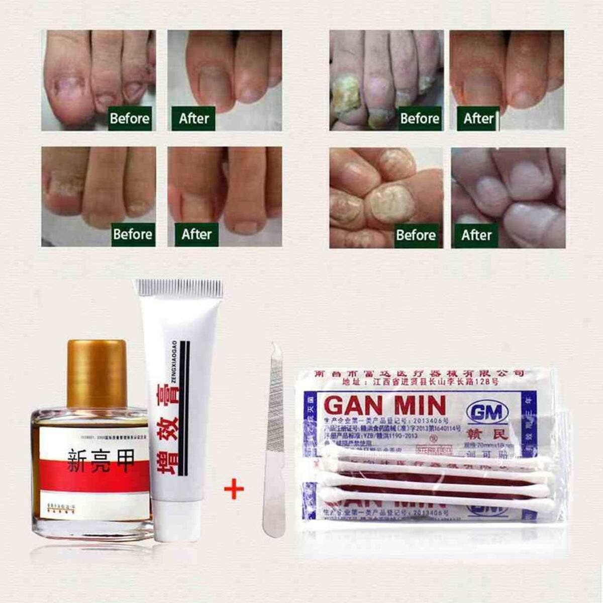 Набор для удаления грибка ногтей, парониурита, инфекции ногтей, серый инструмент для удаления ногтей B4