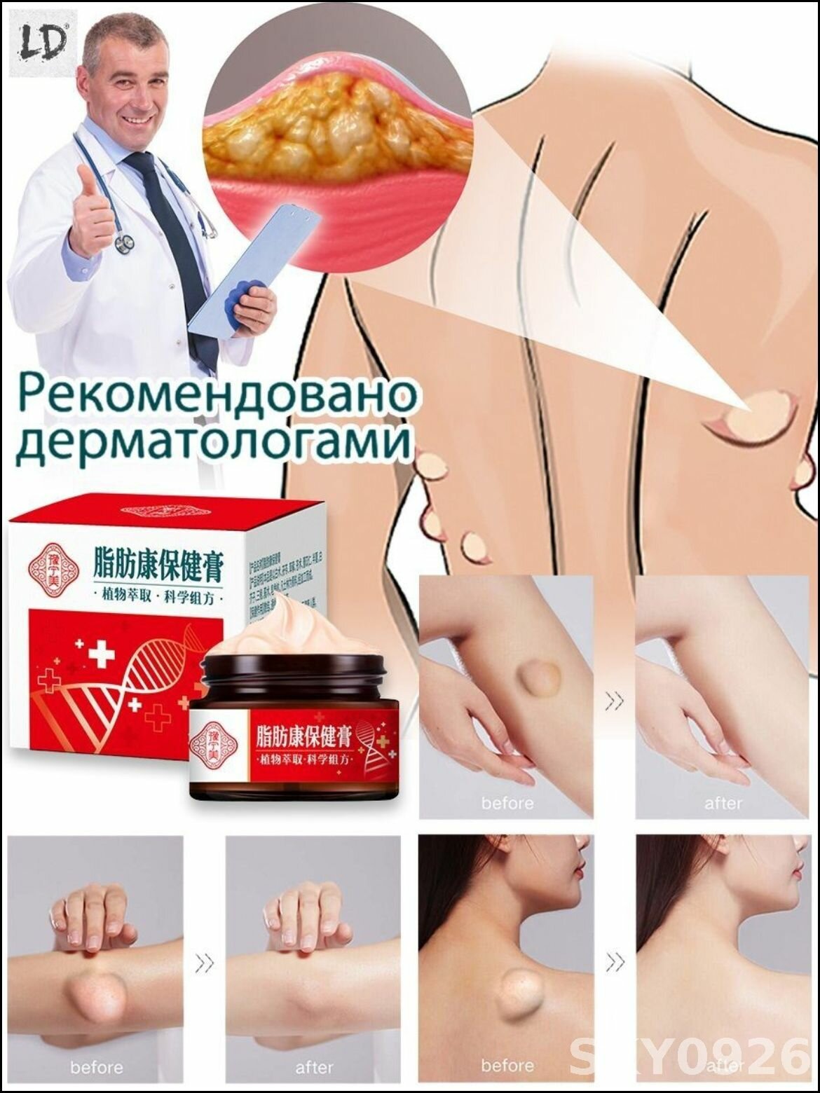 Мазь от липомы, Быстрое и безопасное удаление жировиков,30 г