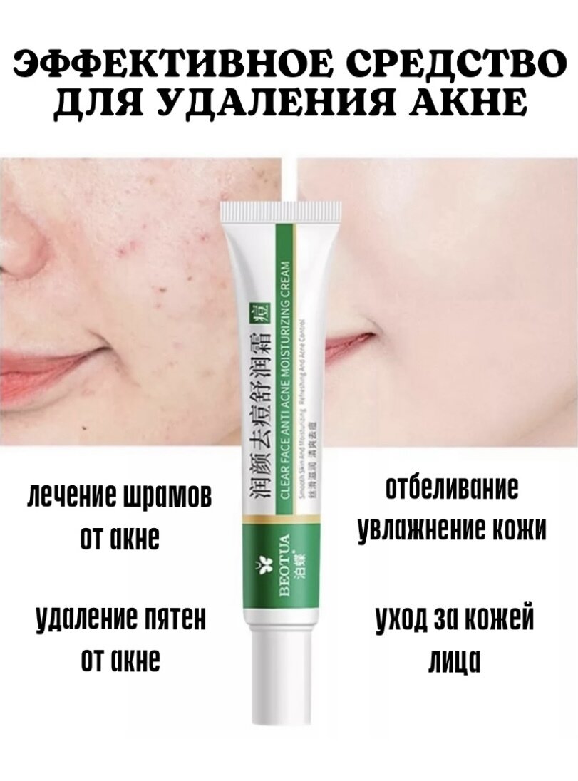 Крем для лечения акне угрей/От прыщей для проблемной кожи лица угревой сыпи/Лечение шрамов удаление пятен от прыщей акне/Уход за проблемной кожей