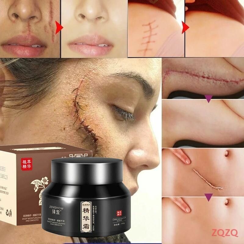 Средство от растяжек