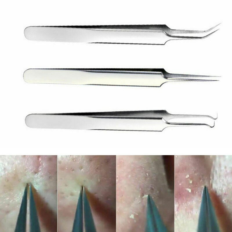 Иглы для удаления прыщей, удаление угрей, прыщи, набор экстракторов комедонов, прыщи, прыщи, средства для ухода за кожей лица, очиститель, инструменты для удаления
